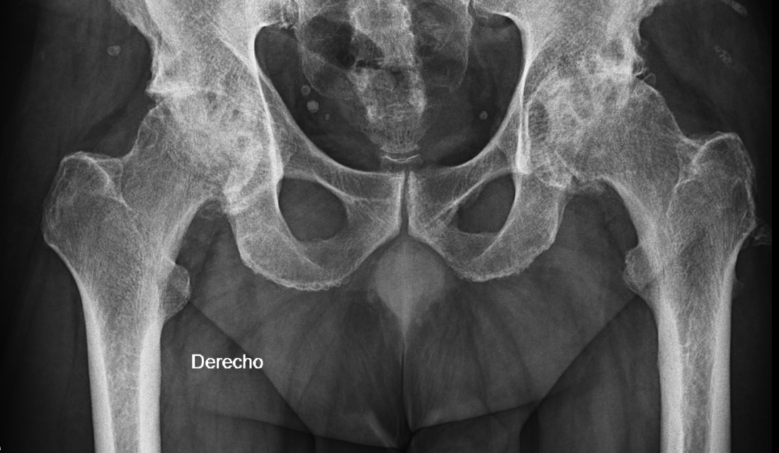 Hombre, 54 años. Artrosis de cadera izquierda. :: Drmauroandreoli-com-ar